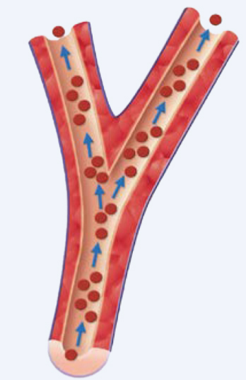 Understanding PAH | What is PAH